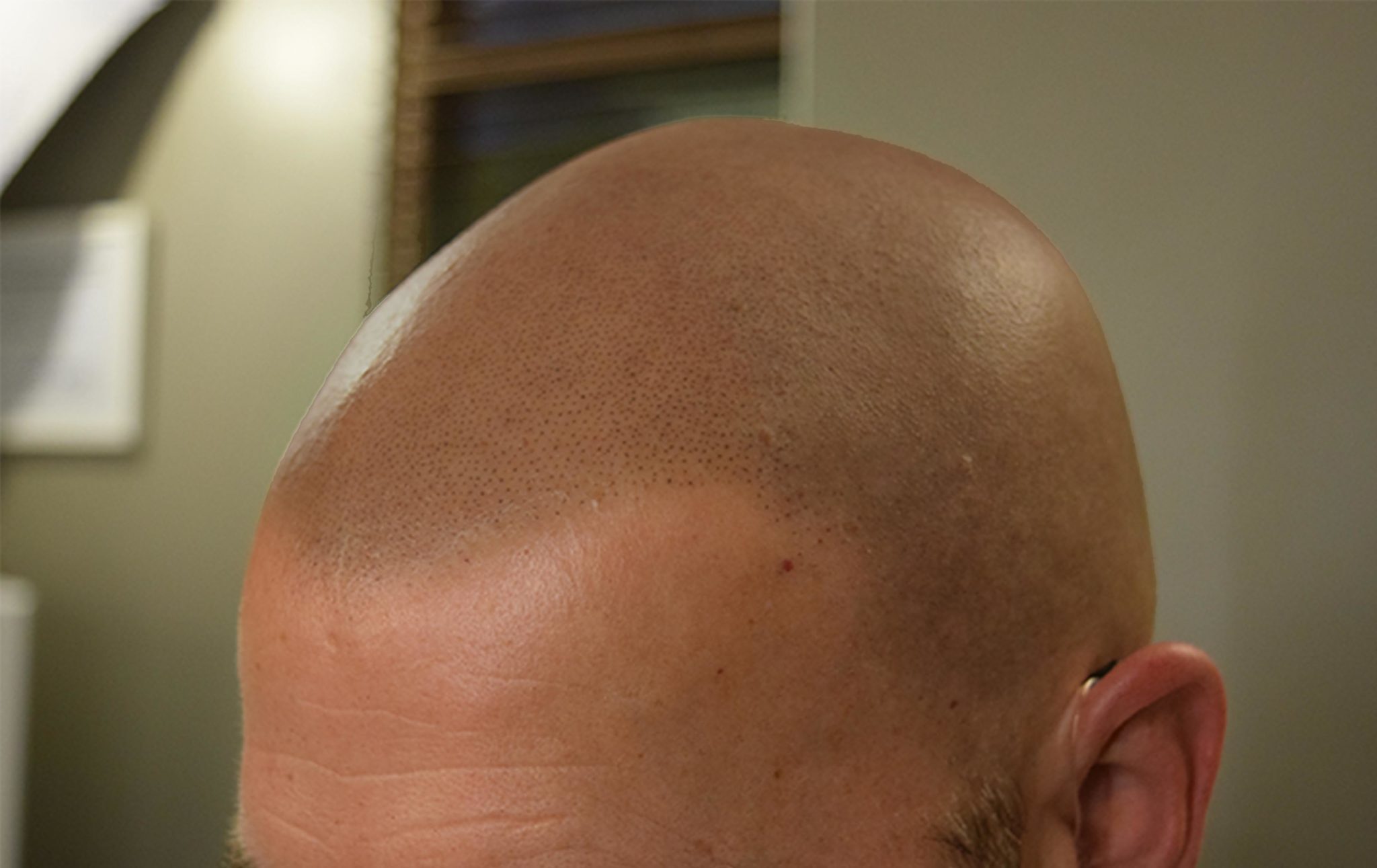 Before and After - DermiMatch Hair Clinic | Scalp Micropigmentation ...