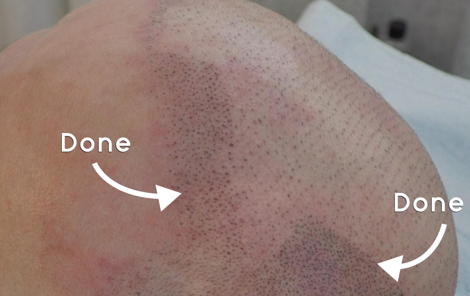 Main SMP Challenges - DermiMatch Hair Clinic | Scalp Micropigmentation ...