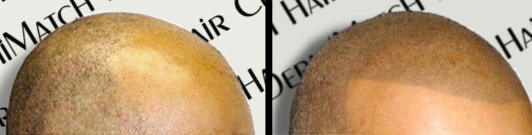 Psoriasis Hair Loss: Does SMP Help Inflammatory Scalp Conditions ...